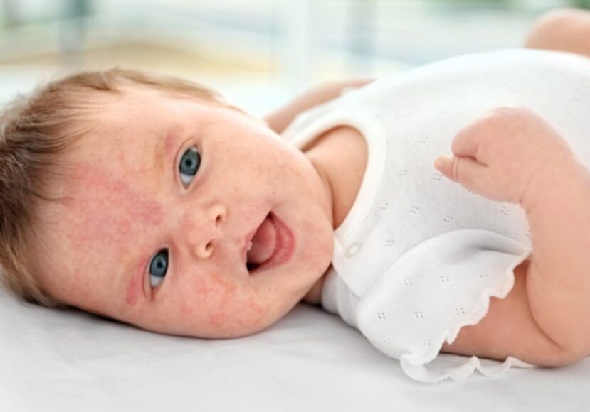Eczema Recurrence in Babies: How to Prevent It - Dr Parents